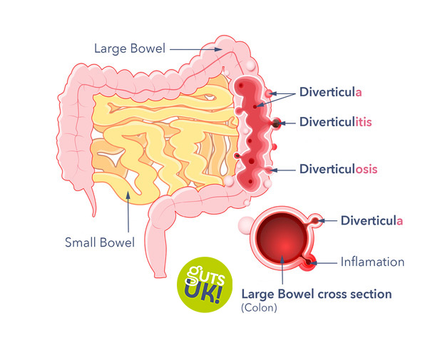 Diet and diverticular disease - BDA