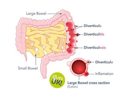 Diet and diverticular disease | British Dietetic Association (BDA)